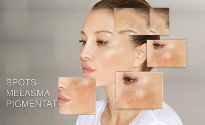 Pigmentflecken: Ursachen & Behandlung - GoAesthetic